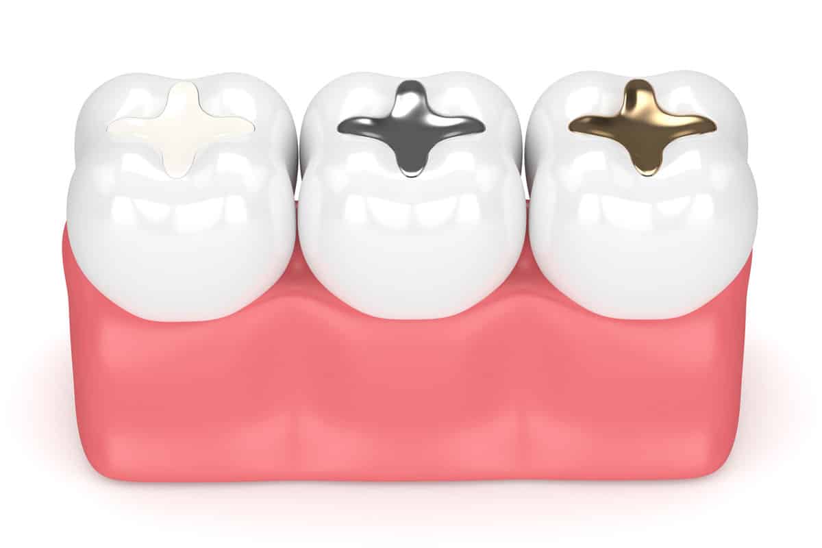 Silver Filling vs White Filling: Which is Better? | Blossom